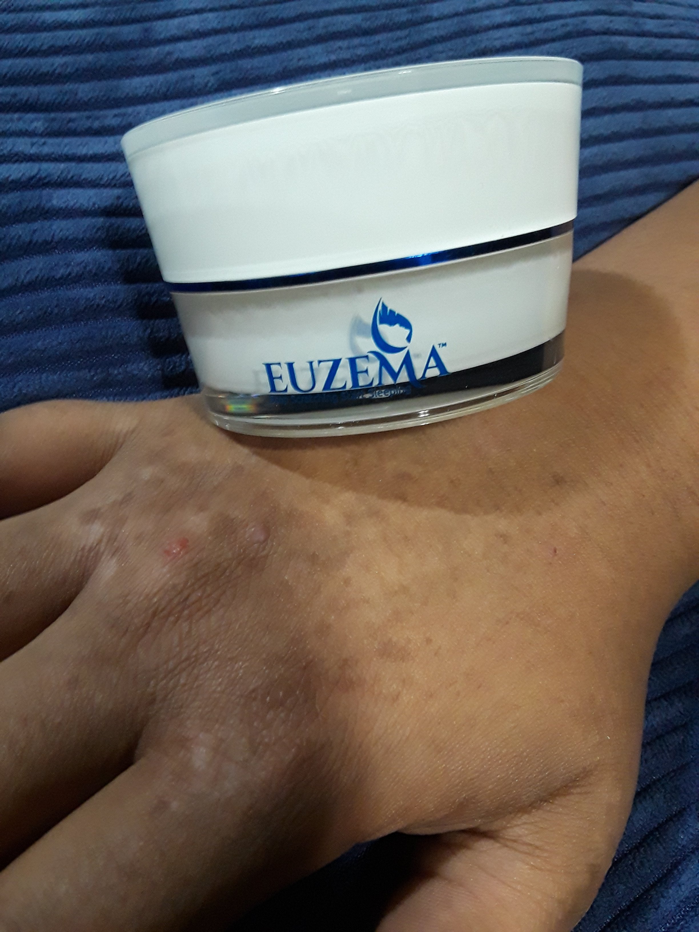 Euzema’s Ezcema Cream Review – LIVING THE DREAM